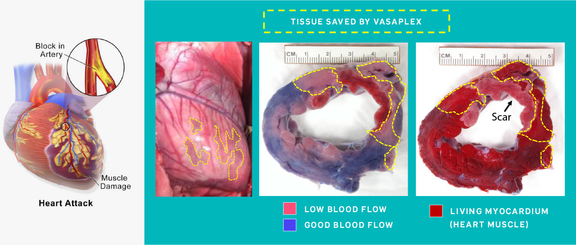 VasaPlex | Saving Tissue After Heart Attacks | Samba BioLogics, Inc